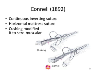 Bowel anastomosis - Why we do things the way we do? | PPTX