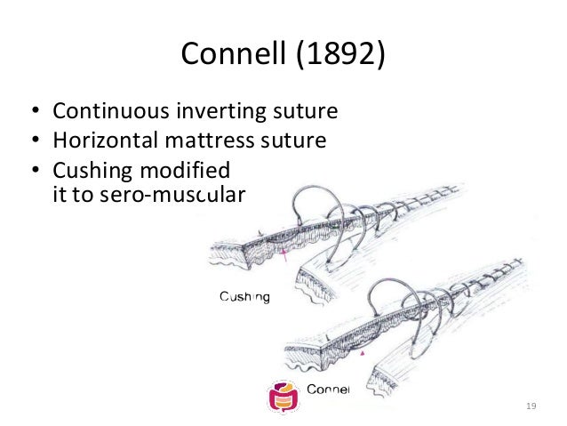 Bowel anastomosis - Why we do things the way we do?