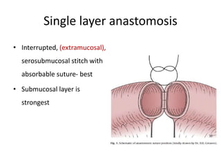 how to perform Safe Bowel anastomosis .pptx