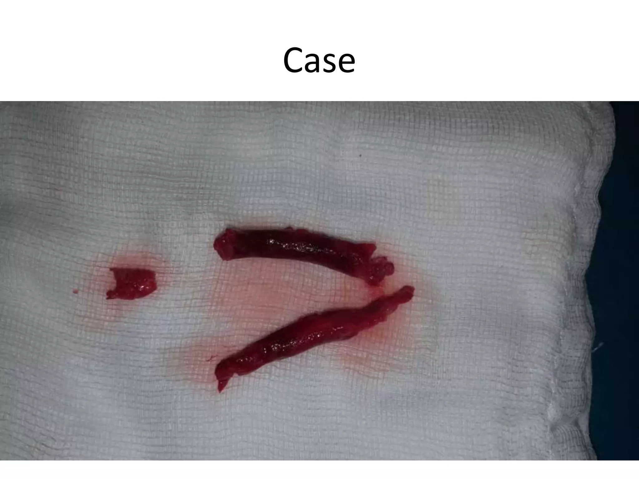 Acute Mesenteric Ischaemia | PPTX