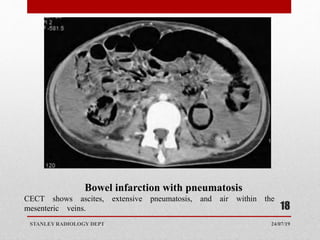 Ischaemic bowel - imaging | PPTX