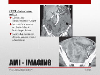 Ischaemic bowel - imaging | PPTX