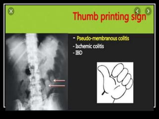 Thumbprint Sign Ischemic Colitis