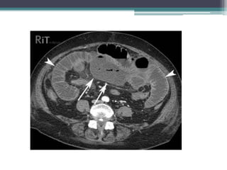 bowel ischemia.pptx