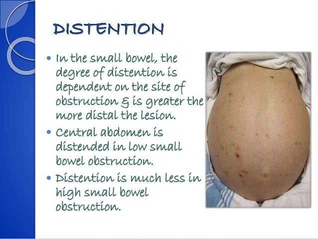 intestinal obstruction