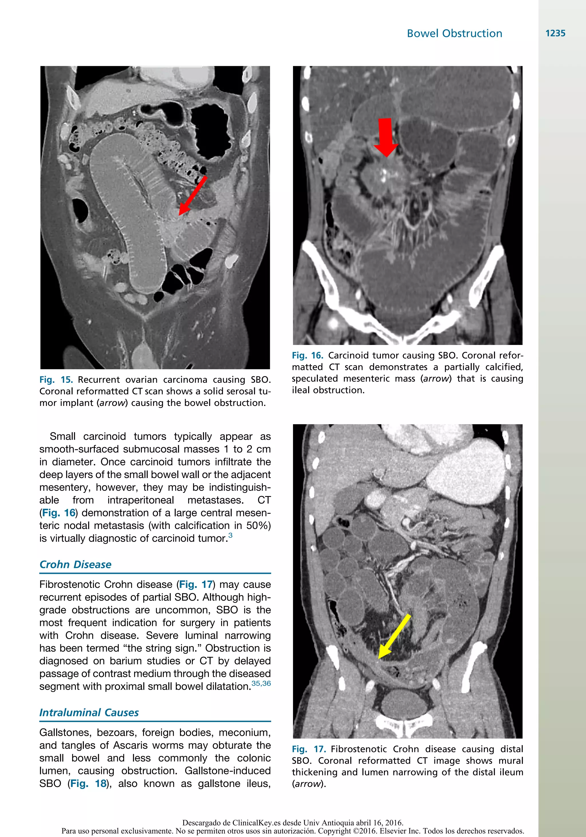 Bowel obstruction - Radiology Clinics 2015 | PDF