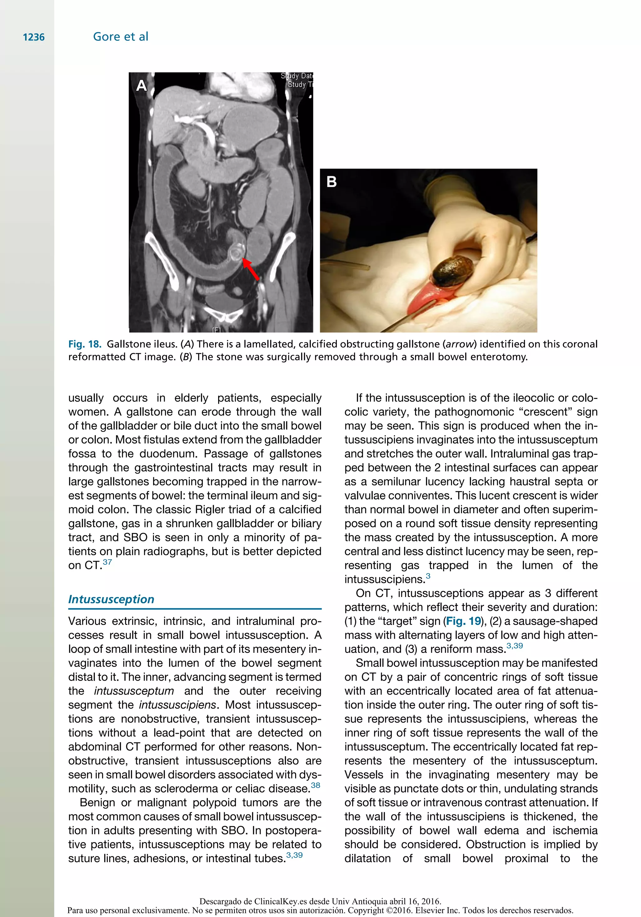 Bowel obstruction - Radiology Clinics 2015 | PDF