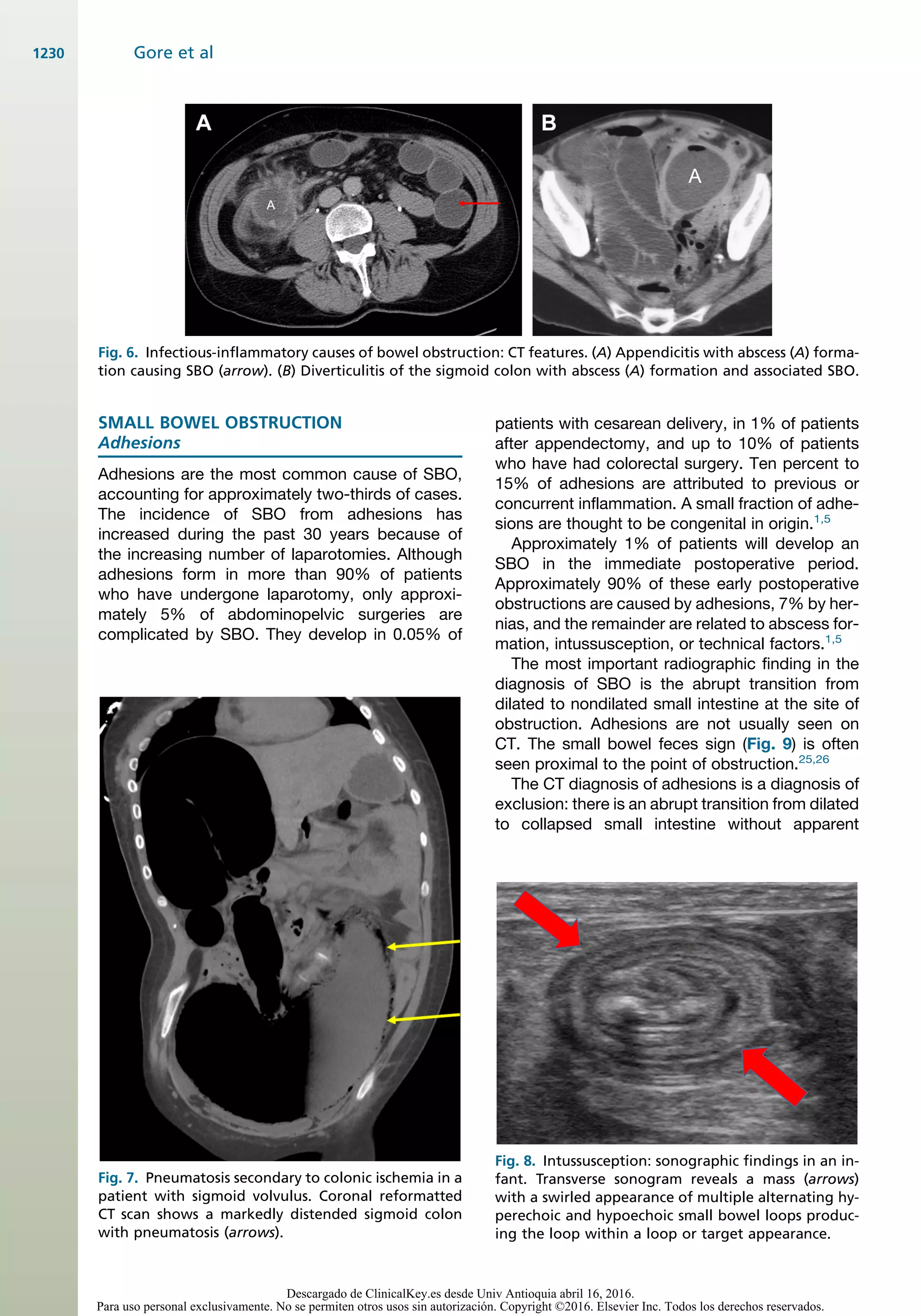 Bowel obstruction - Radiology Clinics 2015 | PDF