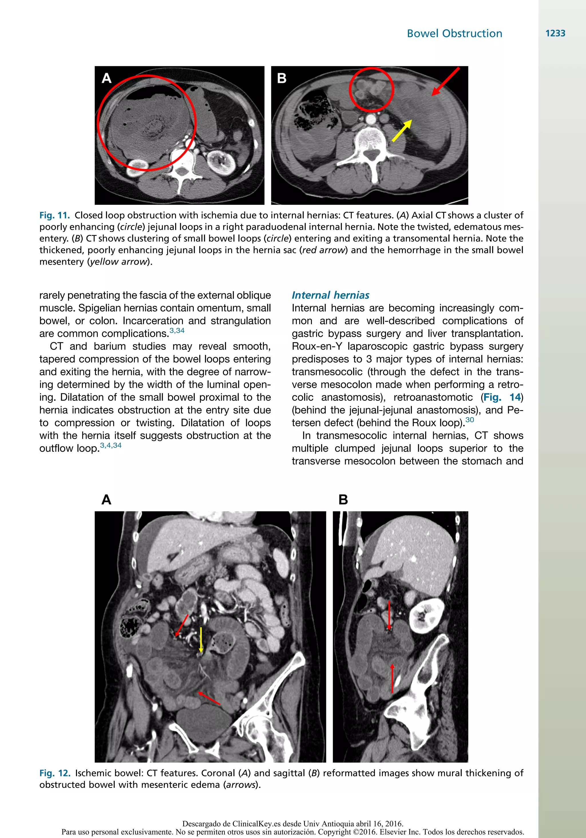 Bowel obstruction - Radiology Clinics 2015 | PDF