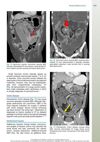 Bowel obstruction - Radiology Clinics 2015 | PDF