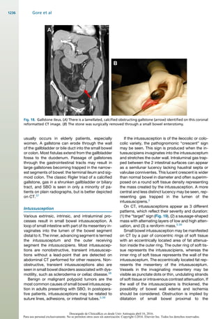 Bowel obstruction - Radiology Clinics 2015 | PDF