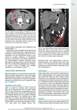 Bowel obstruction - Radiology Clinics 2015 | PDF