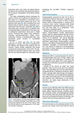 Bowel obstruction - Radiology Clinics 2015 | PDF