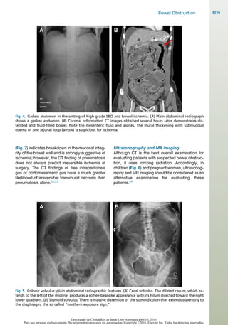 Bowel obstruction - Radiology Clinics 2015 | PDF