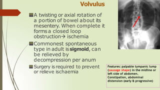 bowelobstruction1-150701160238-lva1-app6891.pptx