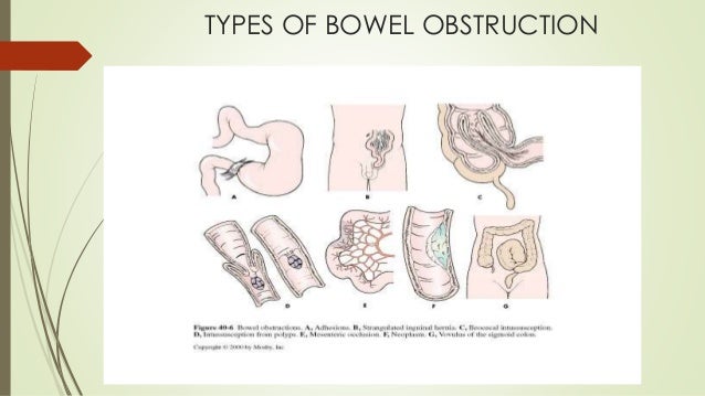 Small Bowel Obstruction Concept Map - Map
