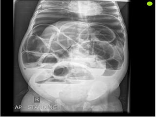 BOWEL PERFORATION AND PERITONITIS .pptx
