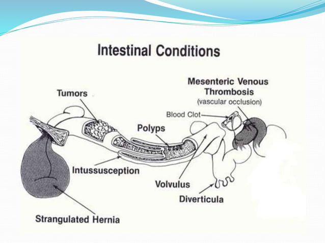 Bowel resection and anastomosis | PPTX