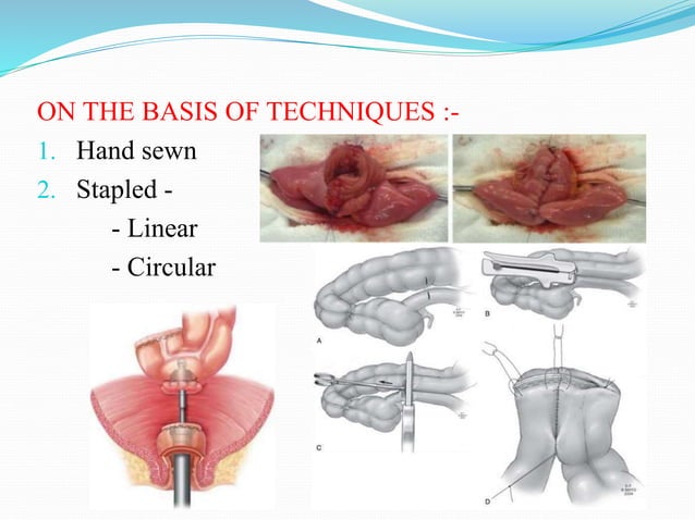 Bowel resection and anastomosis | PPTX