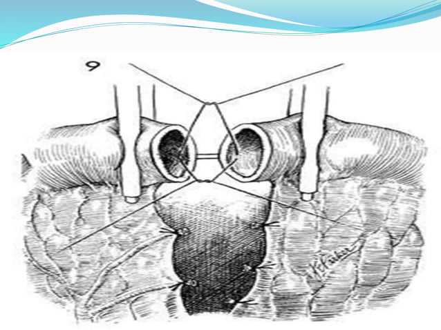 Bowel resection and anastomosis | PPTX