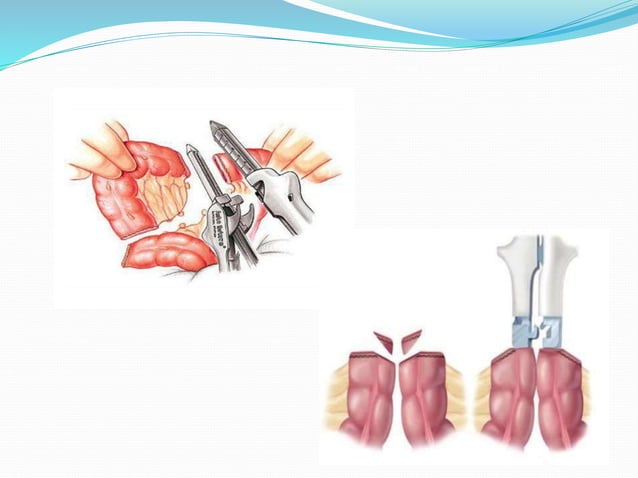 Bowel resection and anastomosis | PPTX