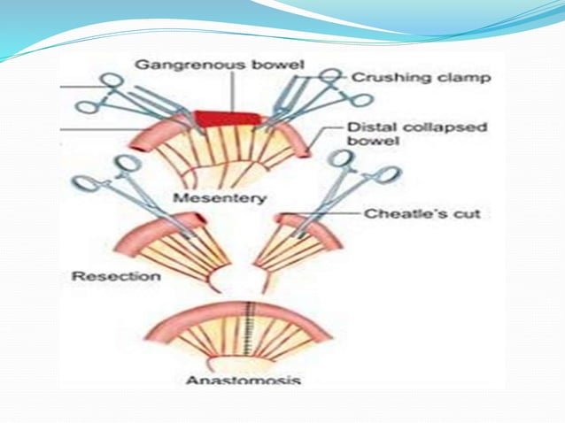 Bowel resection and anastomosis | PPT