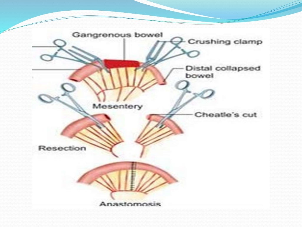 Bowel resection and anastomosis