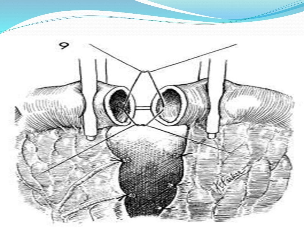 Bowel resection and anastomosis