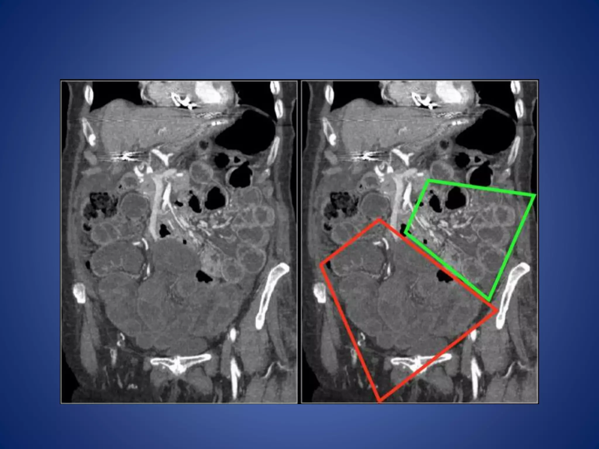 bowel thickening.pptx