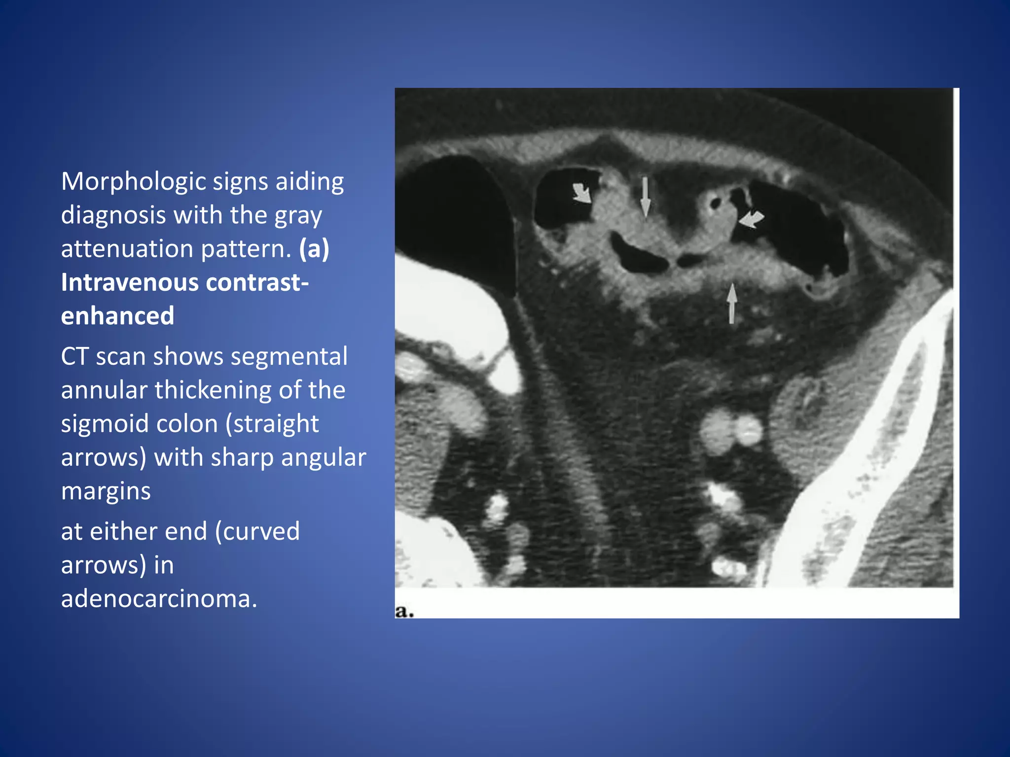 bowel thickening.pptx