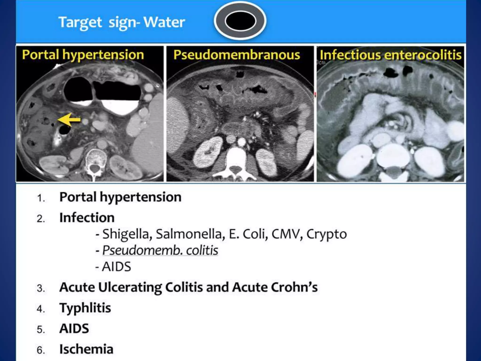 bowel thickening.pptx