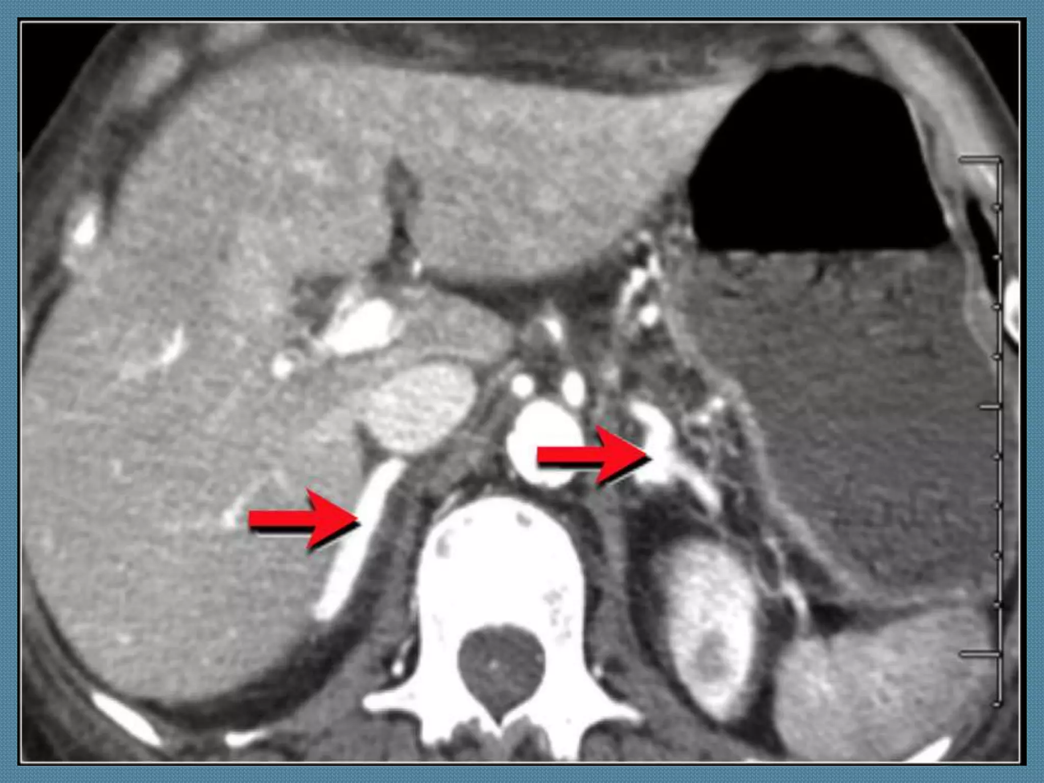 Bowel Wall Thickening CT Pattern | PPTX