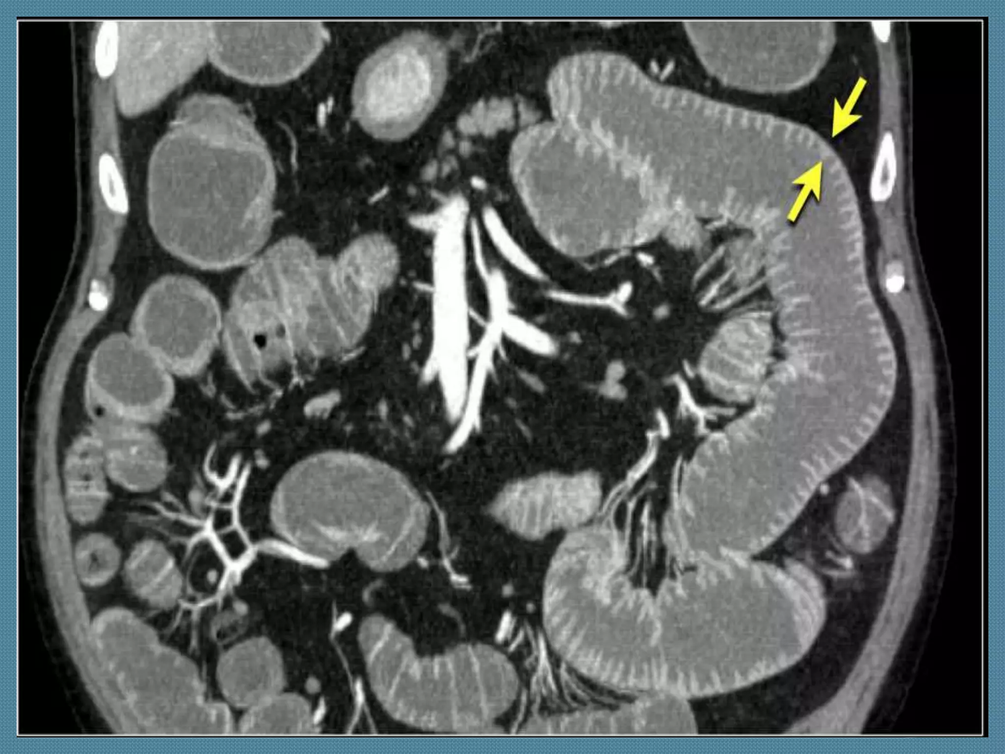 Bowel Wall Thickening CT Pattern | PPTX