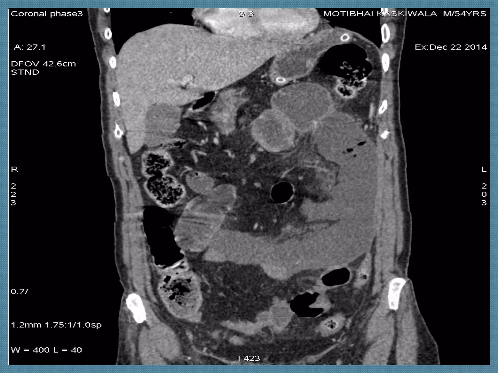 Bowel Wall Thickening CT Pattern | PPTX