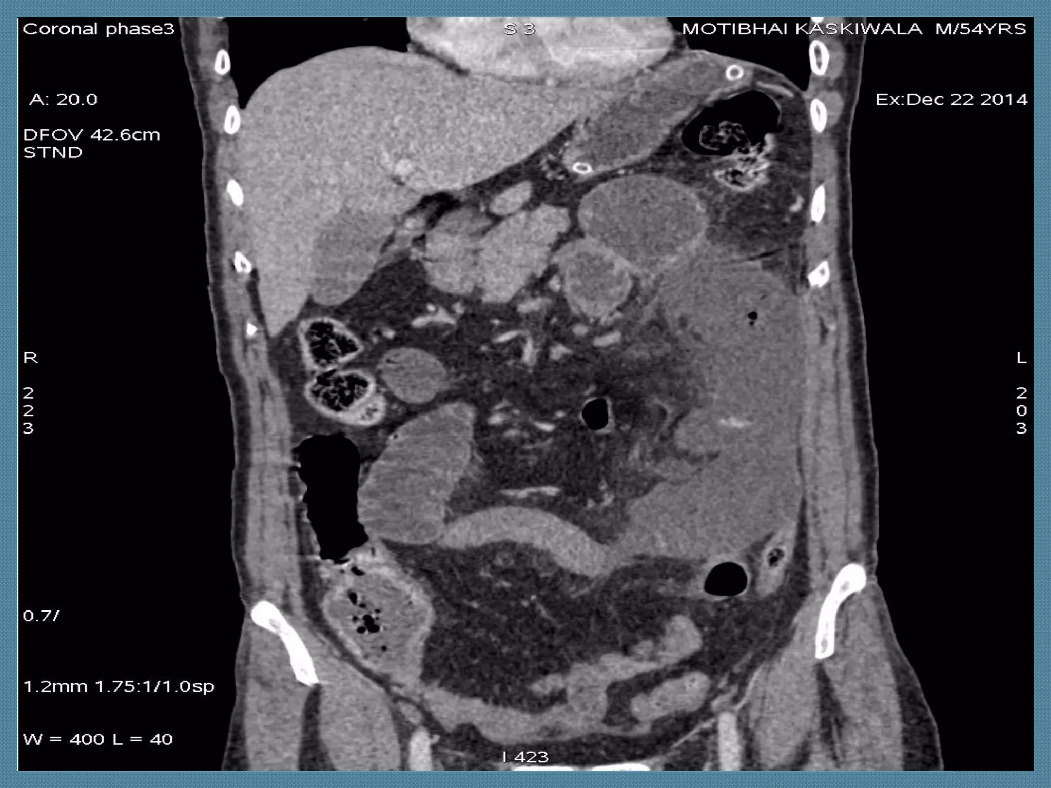 Bowel Wall Thickening CT Pattern | PPTX