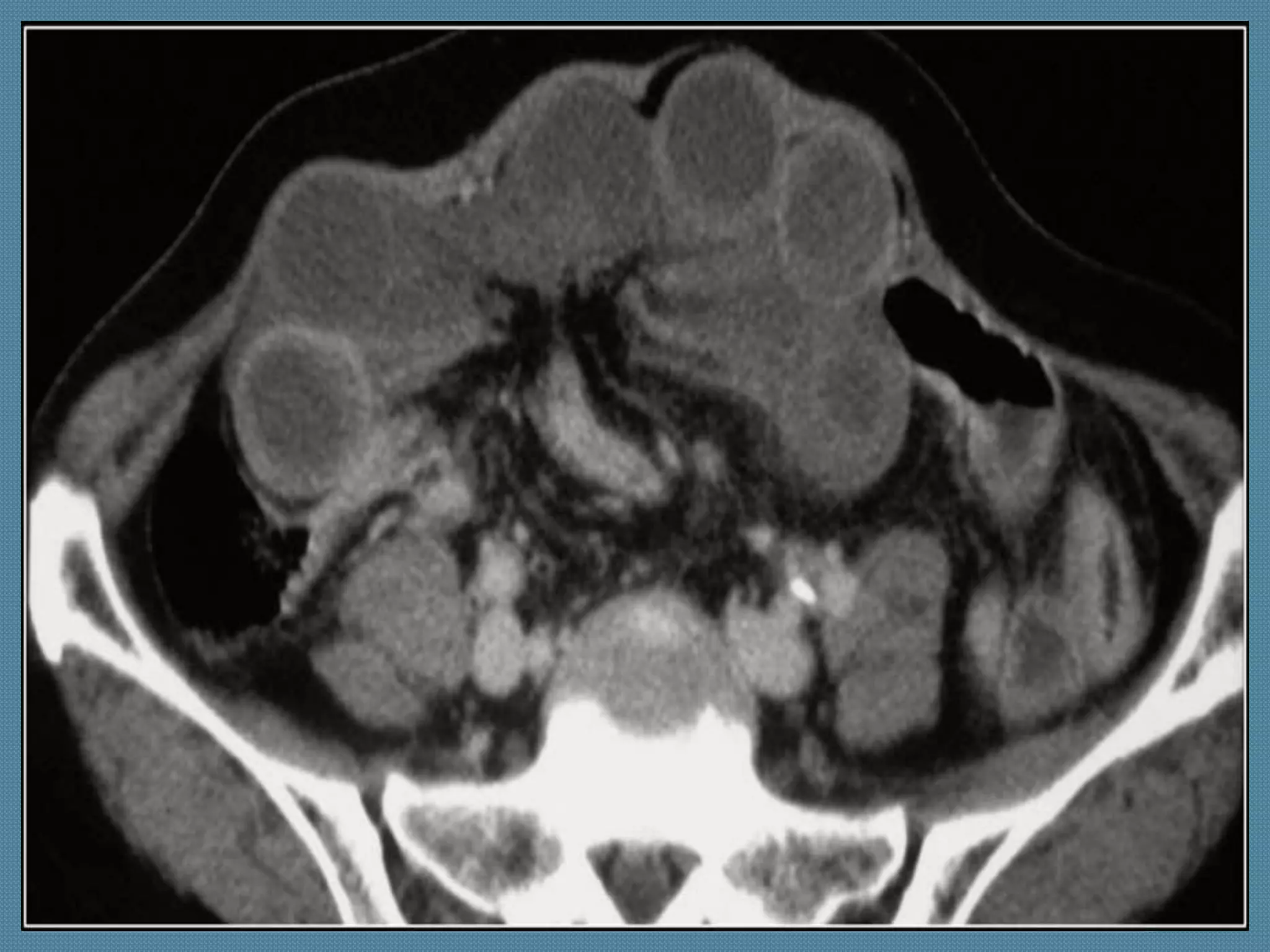 Bowel Wall Thickening CT Pattern | PPTX
