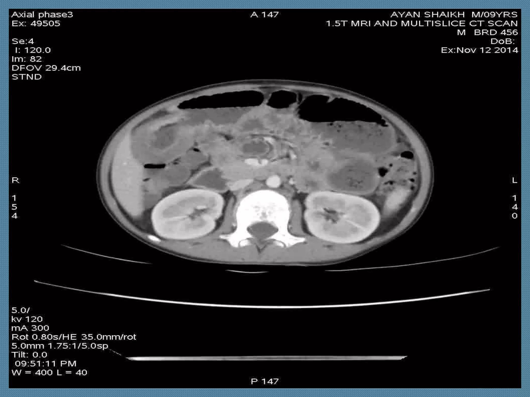 Bowel Wall Thickening CT Pattern | PPTX