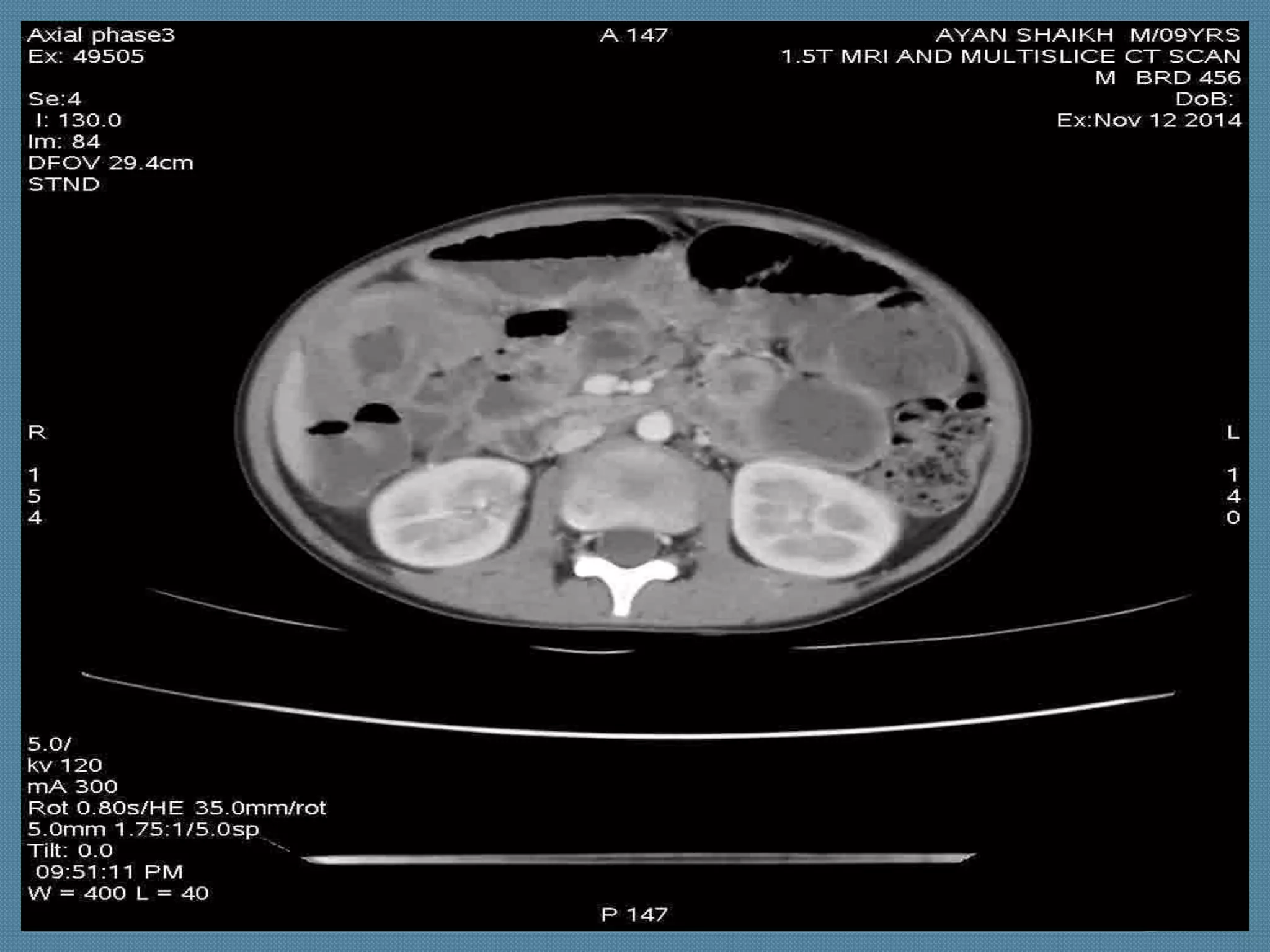 Bowel Wall Thickening CT Pattern | PPTX