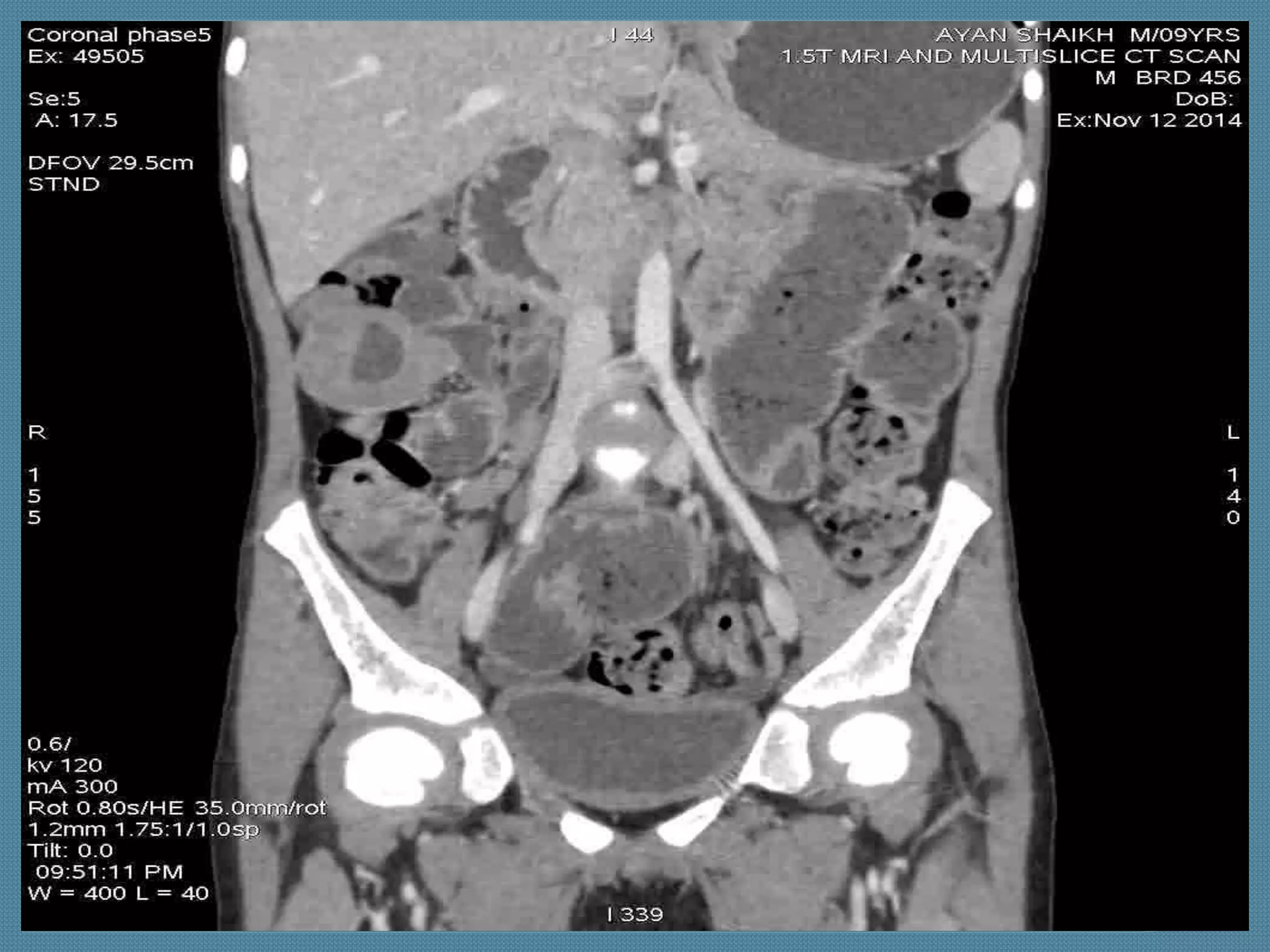 Bowel Wall Thickening CT Pattern | PPTX