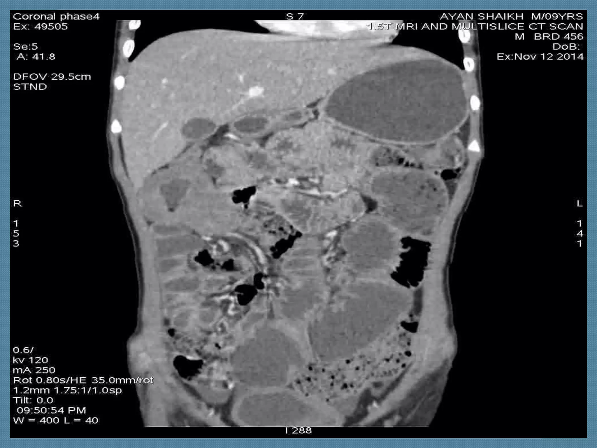 Bowel Wall Thickening CT Pattern | PPTX