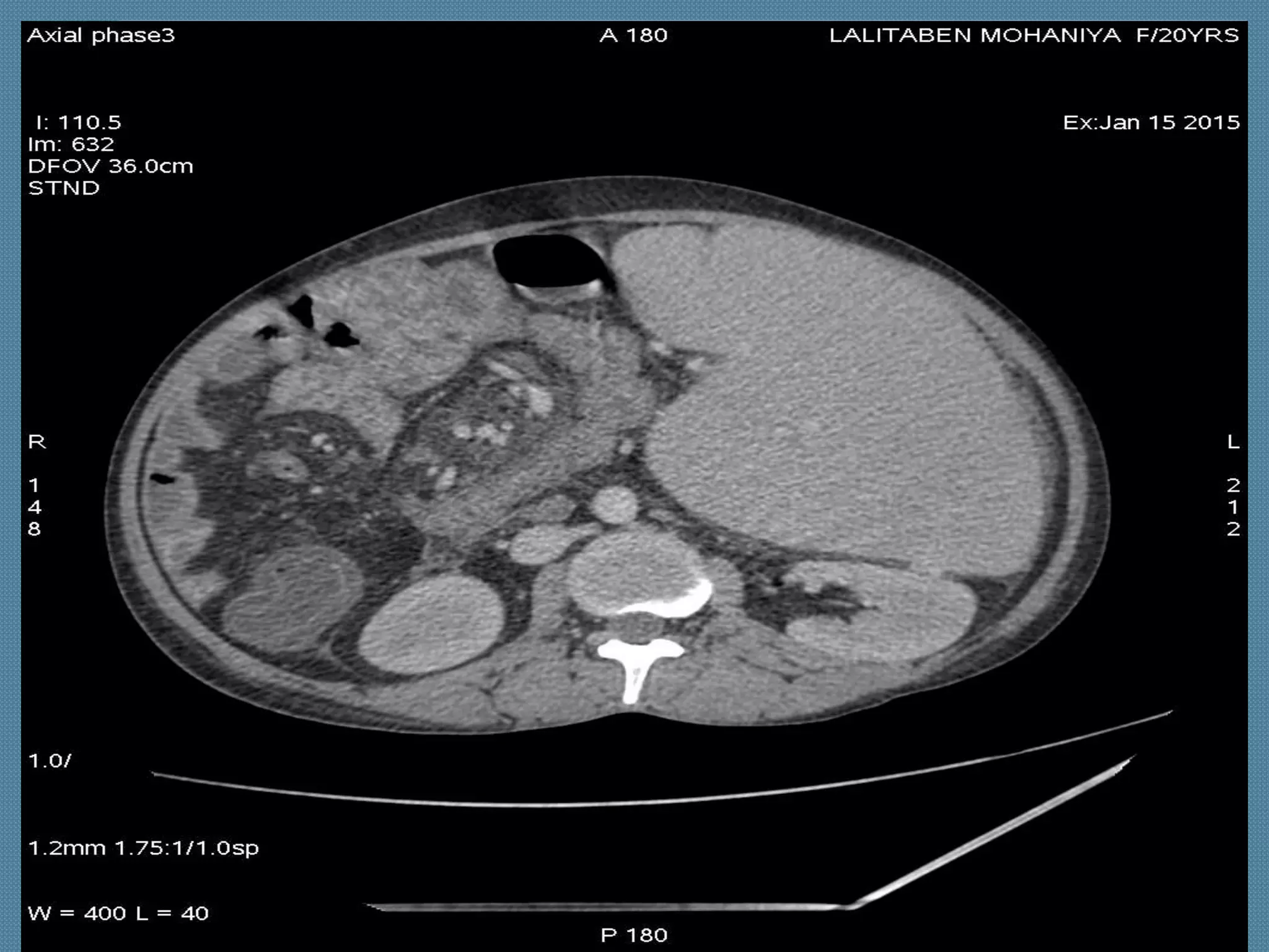 Bowel Wall Thickening CT Pattern | PPTX