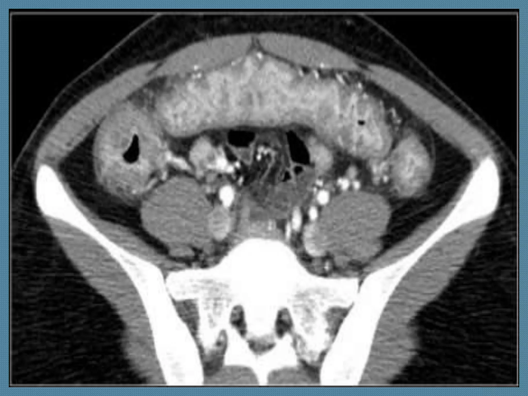 Bowel Wall Thickening CT Pattern | PPTX