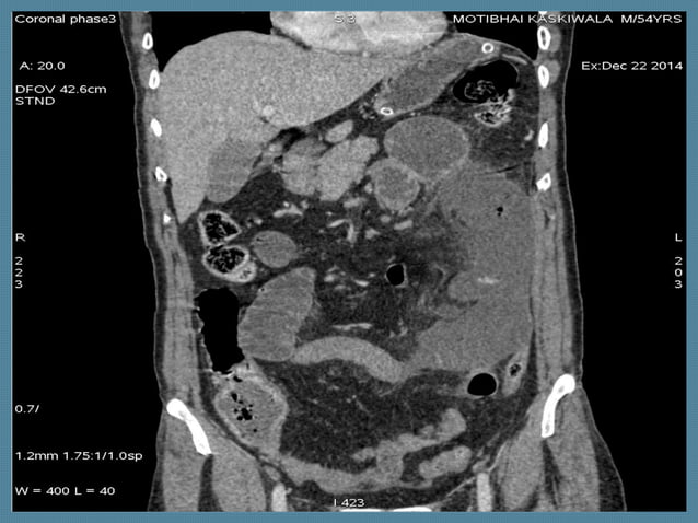 Bowel Wall Thickening CT Pattern | PPTX