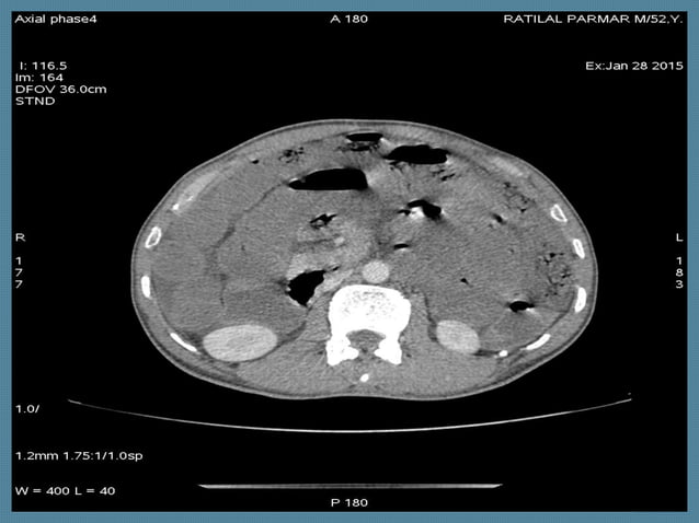 Bowel Wall Thickening CT Pattern | PPTX