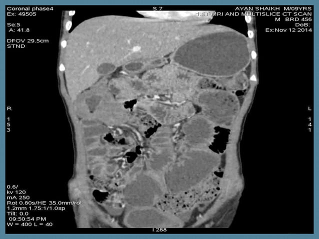 Bowel Wall Thickening CT Pattern | PPTX