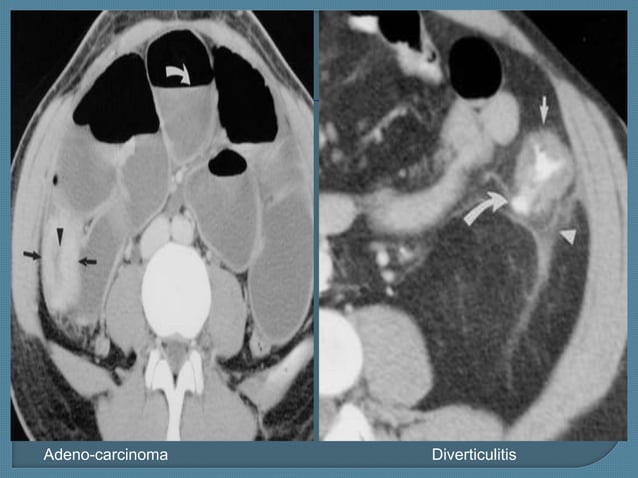 Bowel Wall Thickening CT Pattern | PPTX