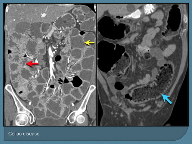 Bowel Wall Thickening CT Pattern | PPTX