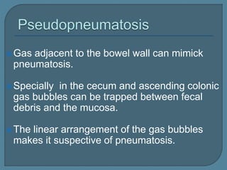 Bowel Wall Thickening CT Pattern | PPTX