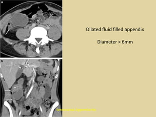 Bowel wall thickening at ct | PPTX