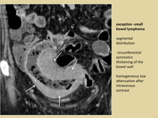 Bowel wall thickening at ct | PPTX